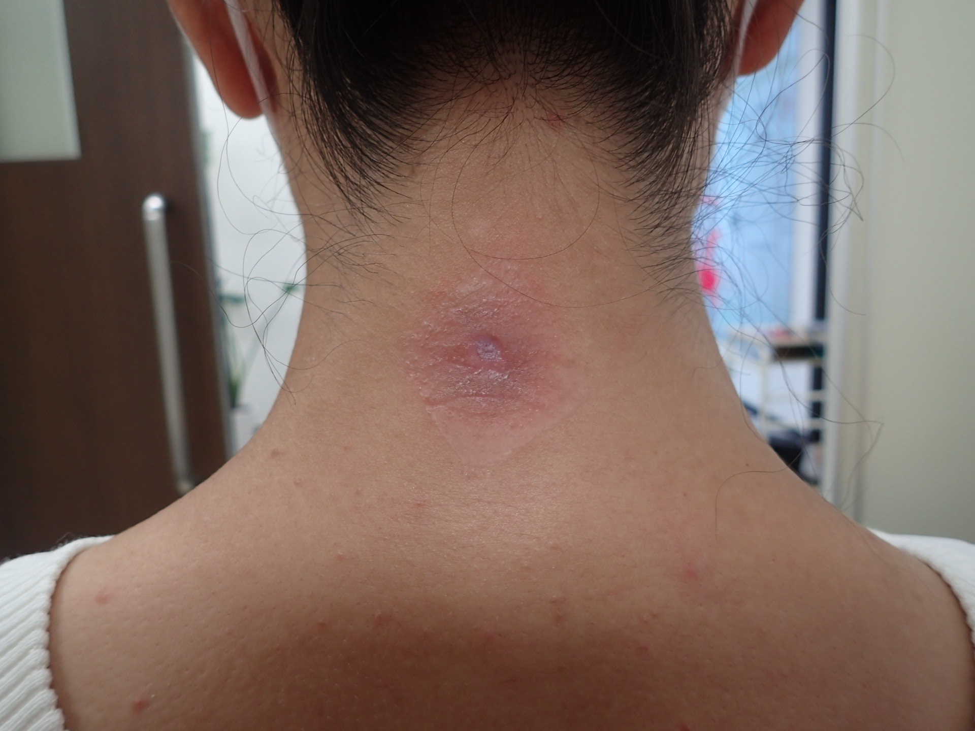 粉瘤（炎症性）｜くりぬき法で手術し、術後4年も傷跡が目立たない症例紹介 - 粉瘤（アテローム） | こおりたひろ整形形成外科クリニック ...