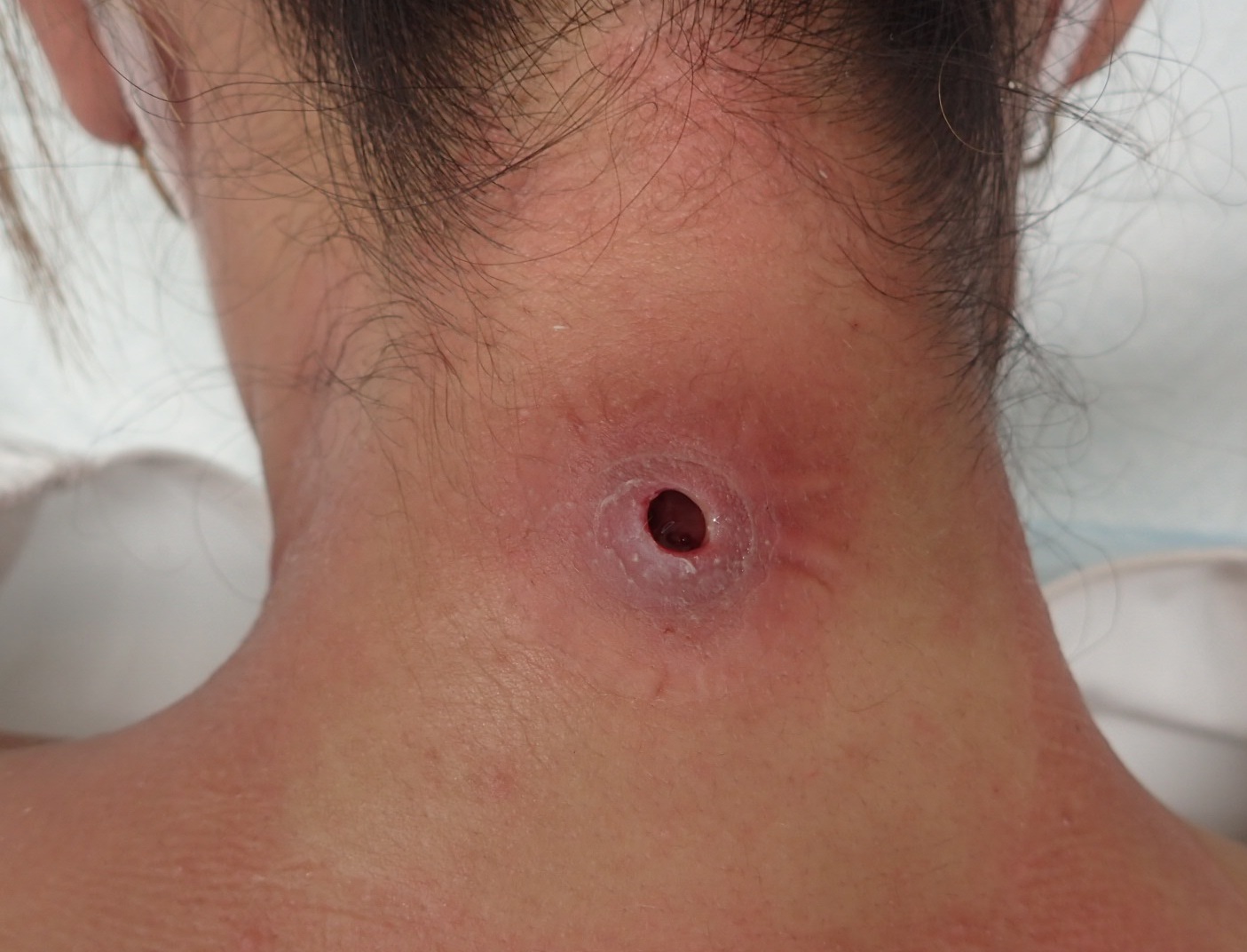 Neck Cyst Removed With Punch Excision｜Scar Barely Visible After 4 Years ...