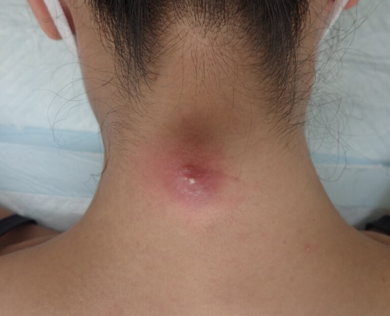 Neck Cyst Removed With Punch Excision｜Scar Barely Visible After 4 Years ...