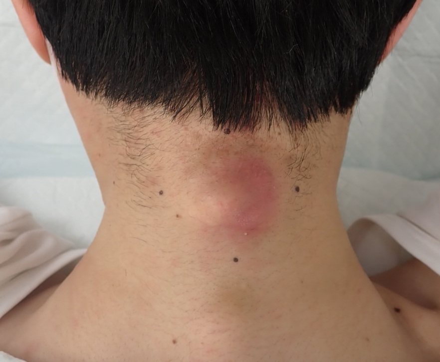 Case of a Neck Epidermoid Cyst Removed by Punch Technique with ...